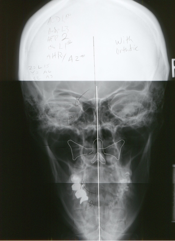 Cranial and Cervical Neck Distortions | Occlusion Connections