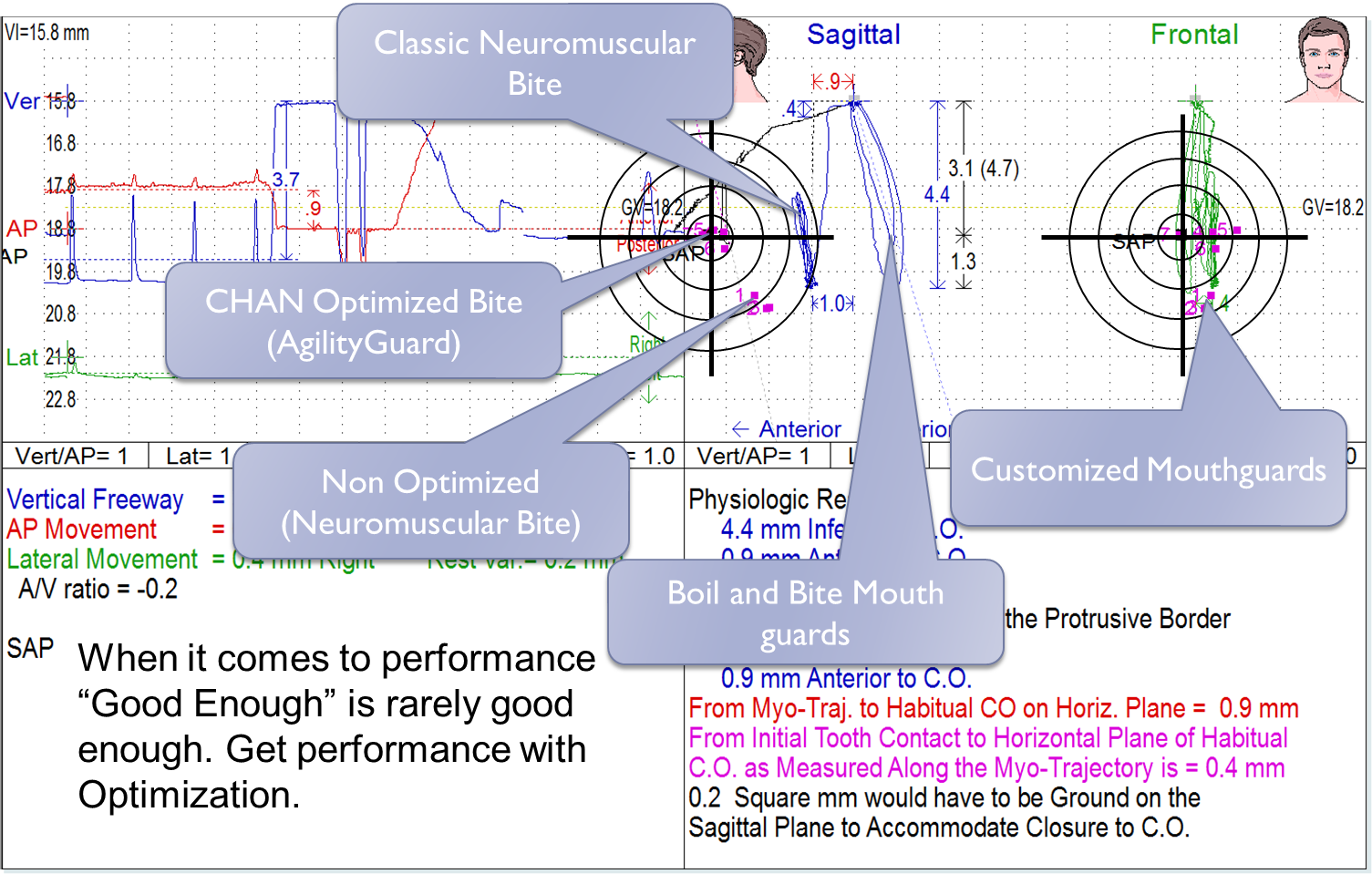 Optimized Bite™ – How It Works | Occlusion Connections