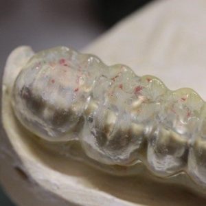 TMJ Orthotic vs Night Guard: What Is the Difference? - Occlusion ...